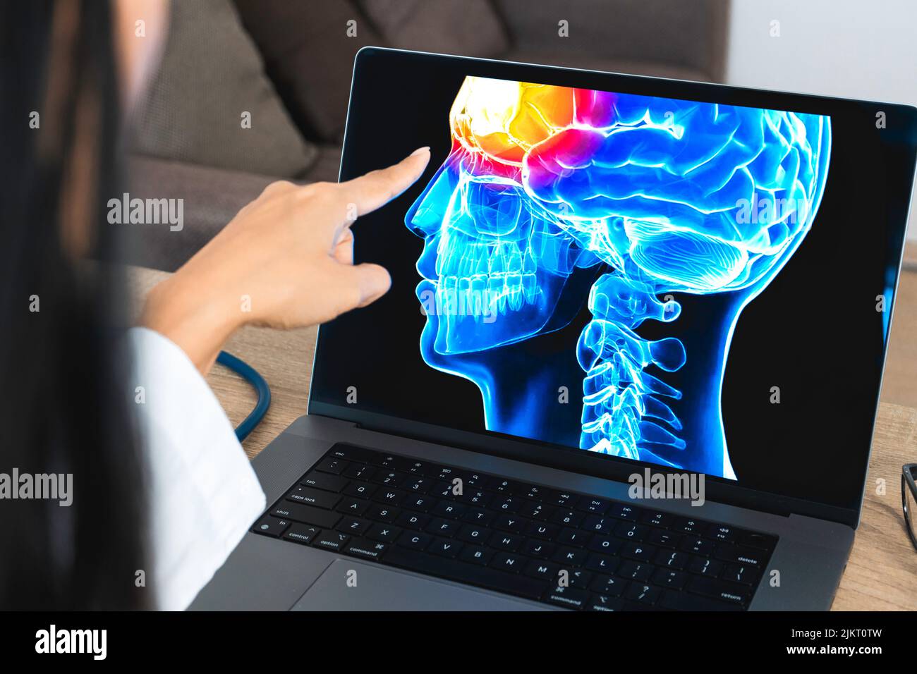 Doctor showing a x-ray of pain in the brain on a laptop. Migraine ...