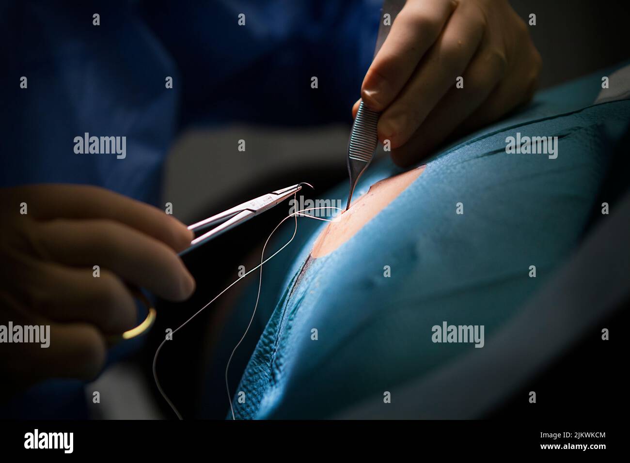 Stitches after removal of a cyst by the dermatologist Stock Photo - Alamy