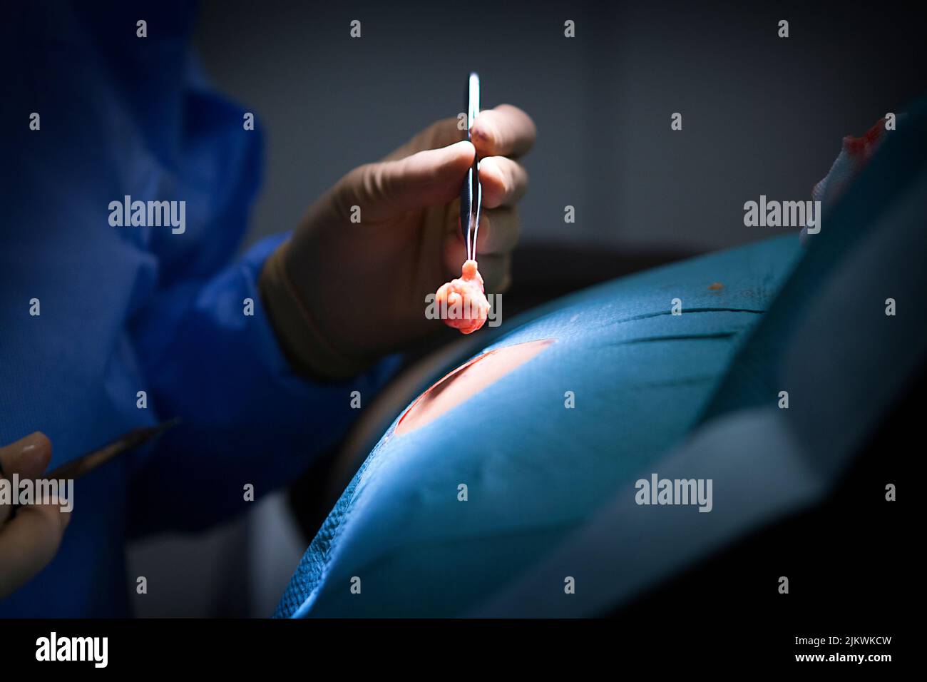 Cyst removal hi-res stock photography and images - Alamy