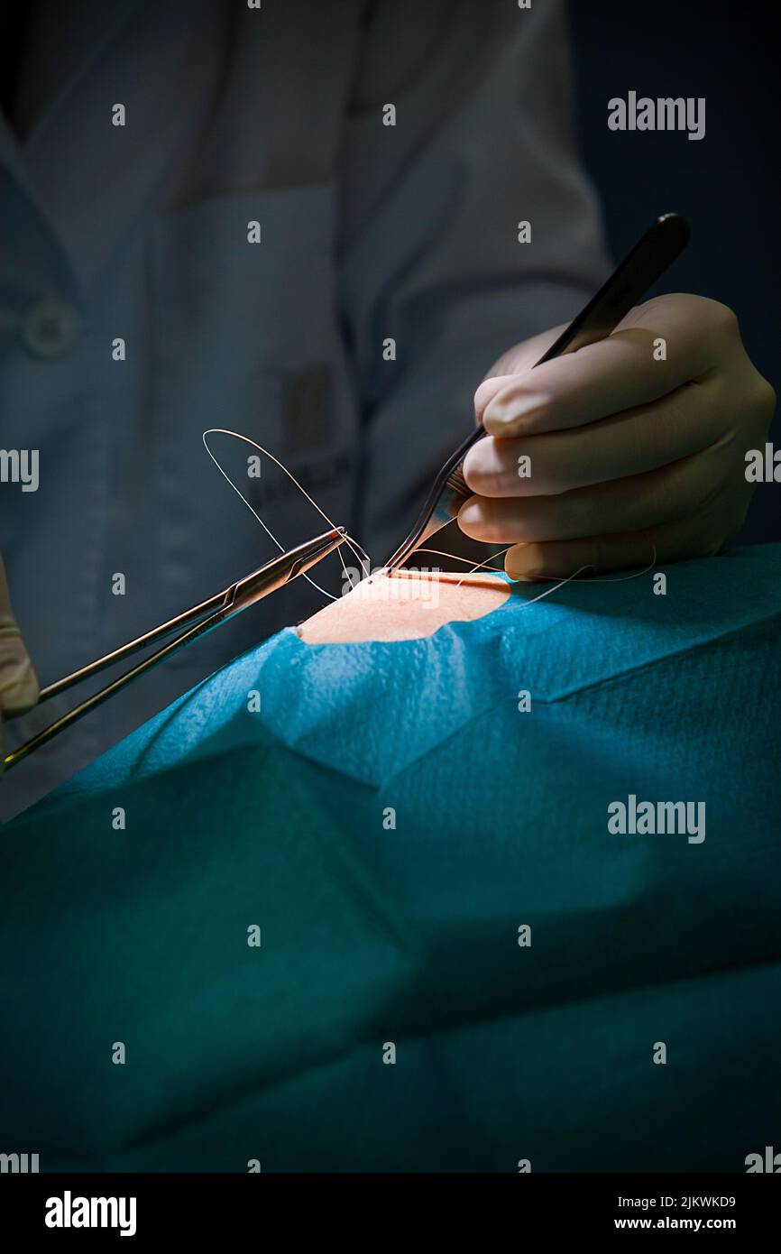 Stitches after removal of a cyst by the dermatologist Stock Photo - Alamy