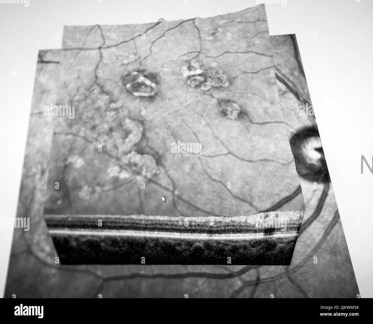 Optical coherence tomography (OCT) showing the optic nerve of a patient ...