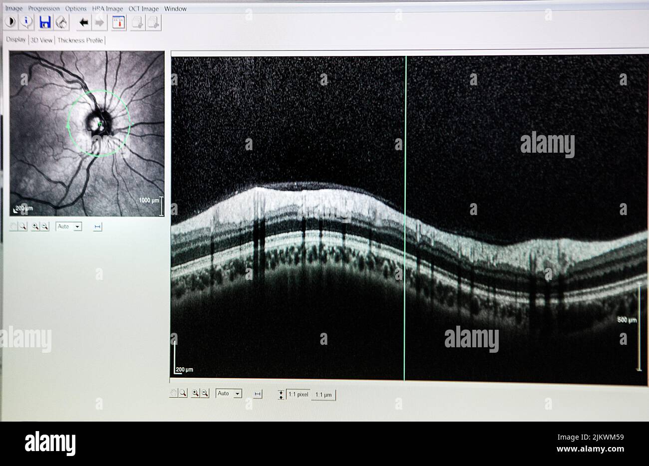 Optical coherence tomography (OCT) showing the optic nerve of a patient ...