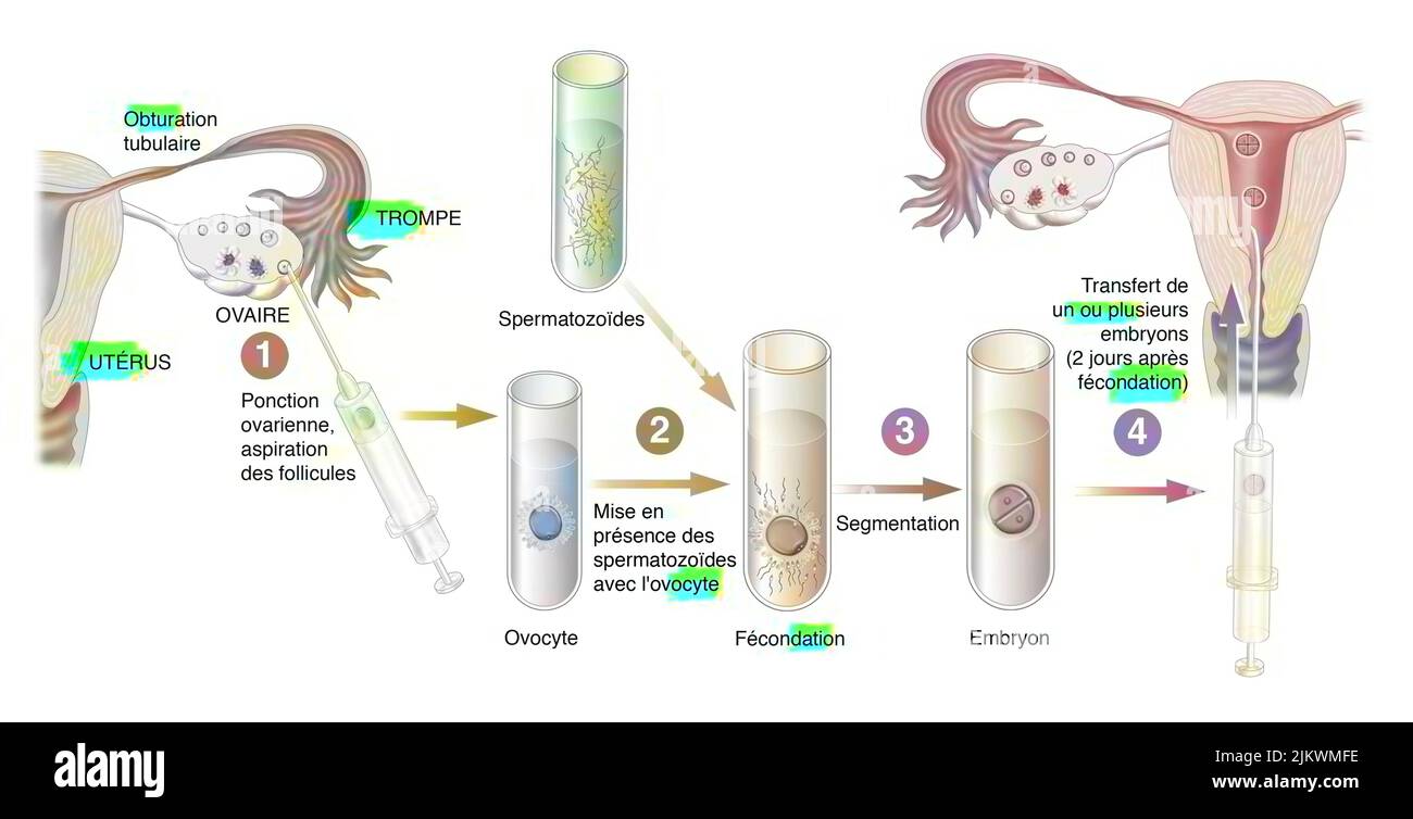 Diagram of the different stages of in vitro fertilization Stock Photo ...