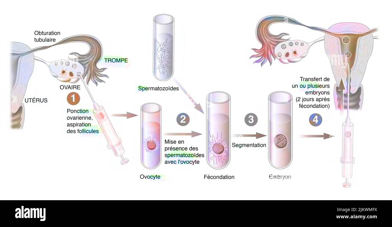 Diagram of the different stages of in vitro fertilization Stock Photo ...