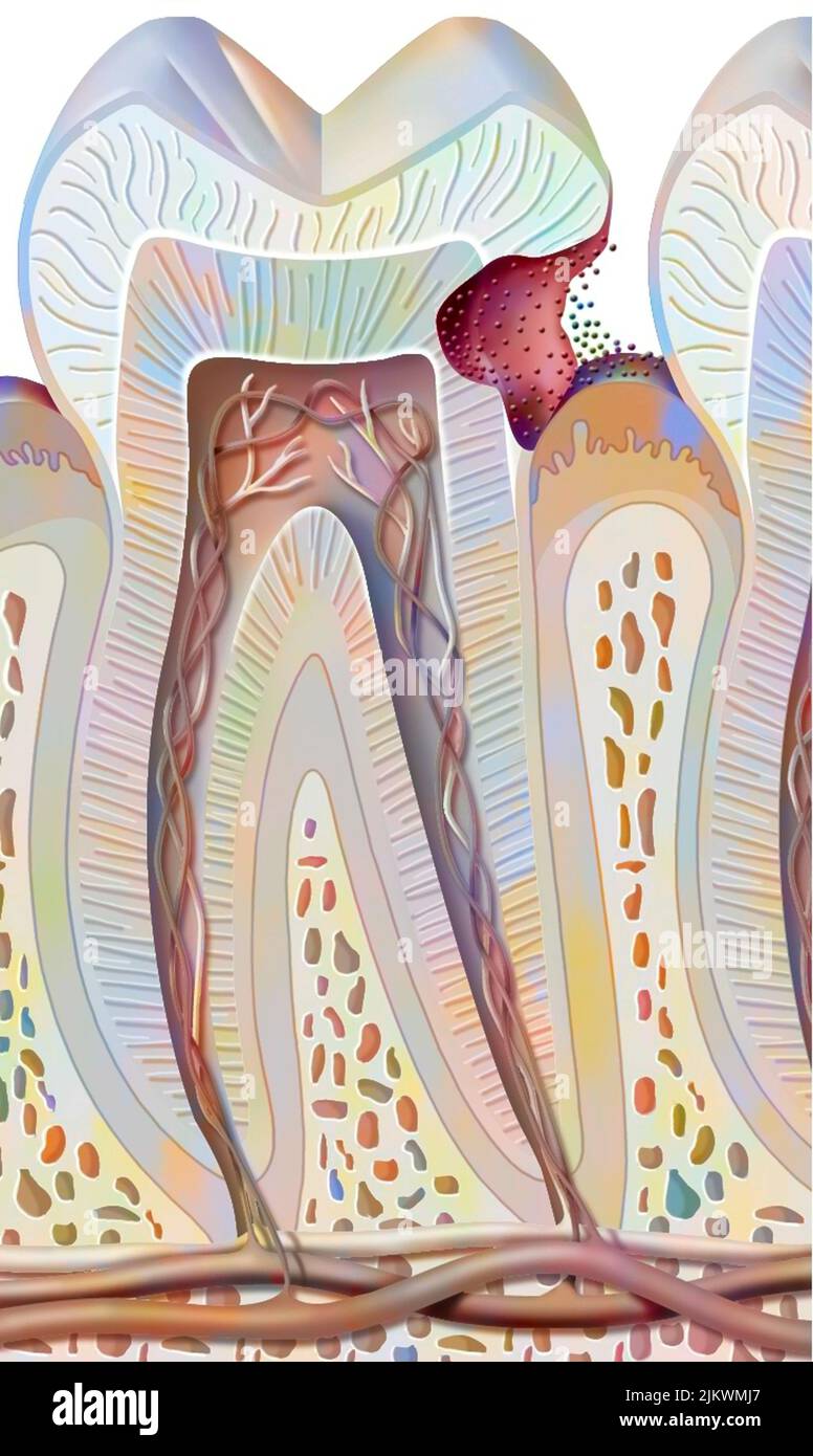 Second stage tooth decay (dentin damage Stock Photo - Alamy