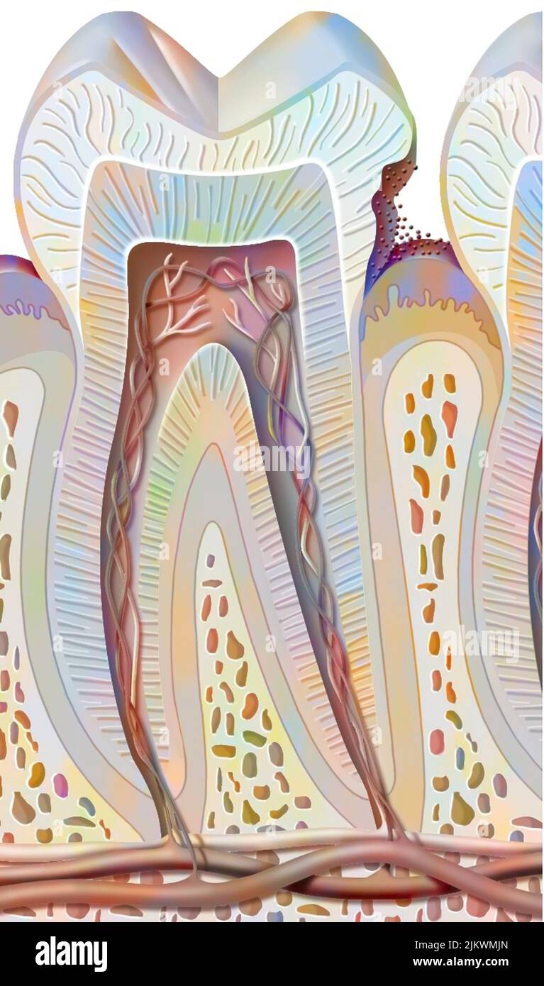 Decay teeth drawing hi-res stock photography and images - Alamy