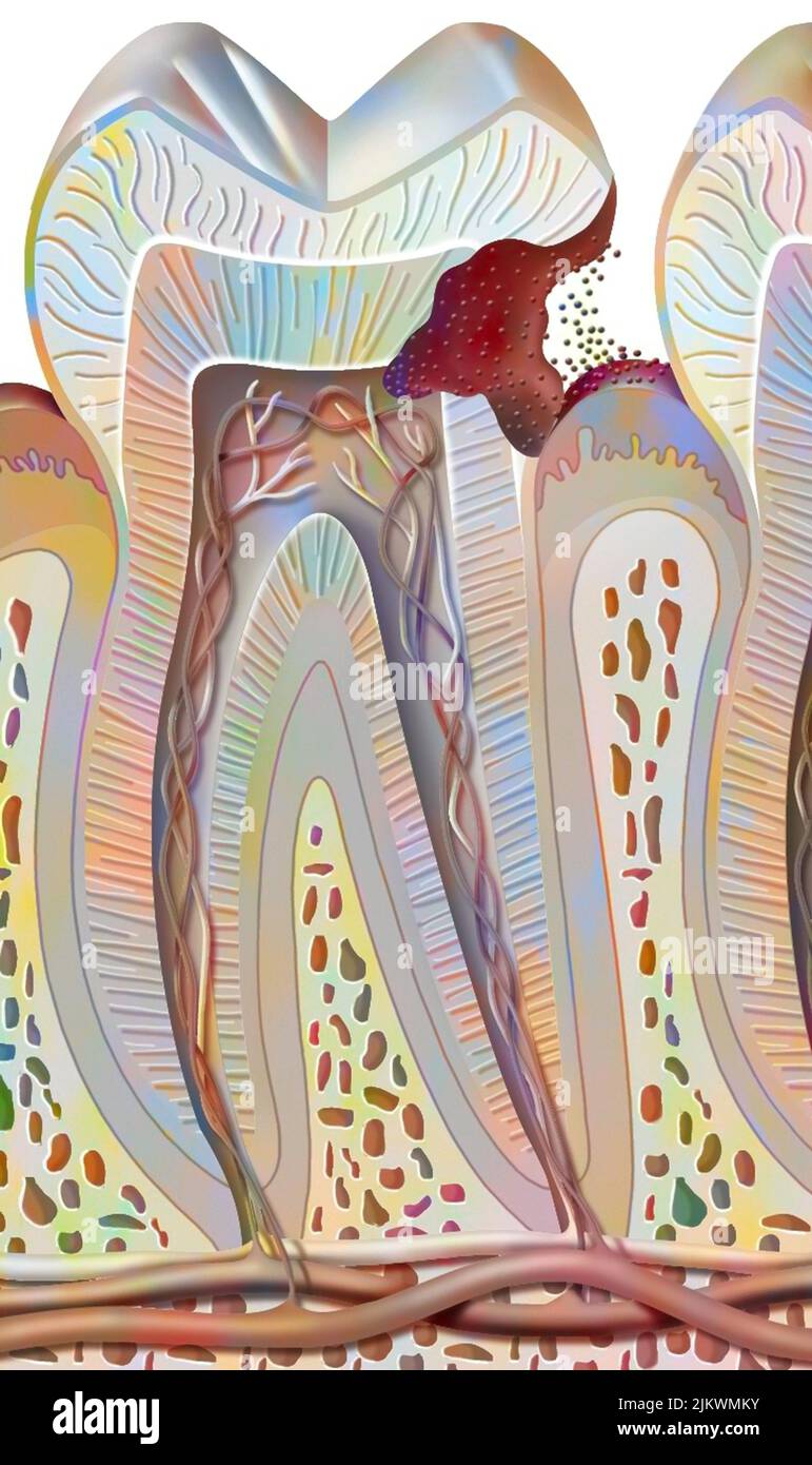 Third stage tooth decay (involvement of the dental pulp Stock Photo - Alamy