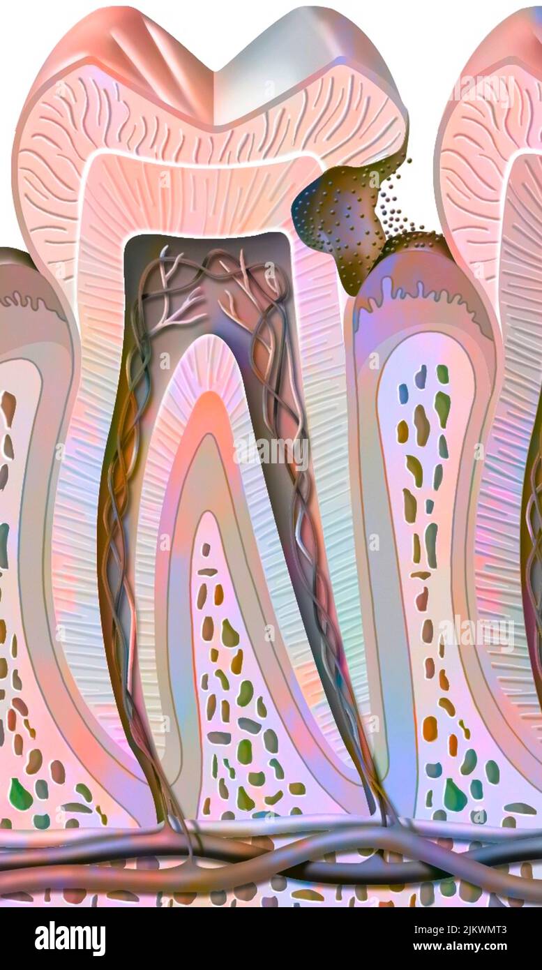Second stage tooth decay (dentin damage Stock Photo - Alamy