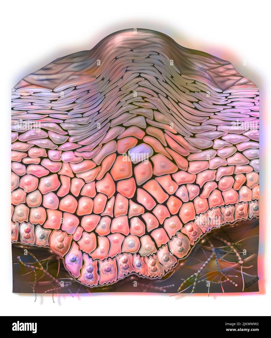 Common wart: benign skin epithelial tumor caused by papillomaviruses ...