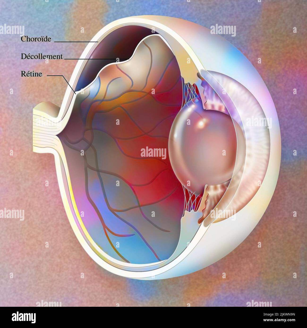 Eye: detachment of the retina, which detaches from the underlying ...