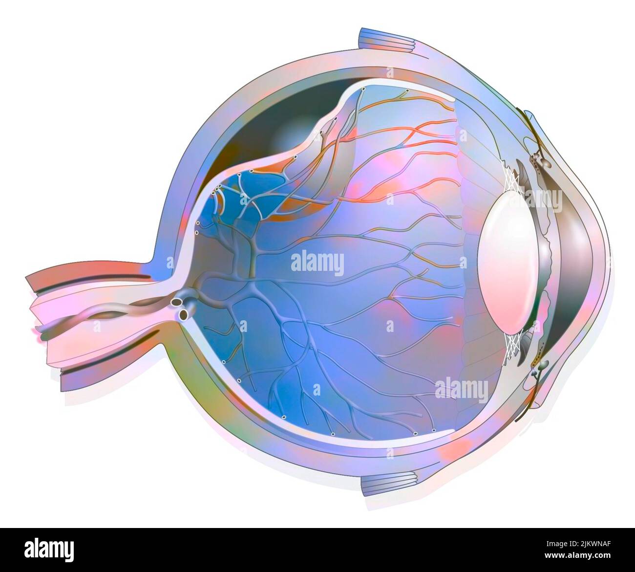 Eye: detachment of the retina, which detaches from the underlying ...