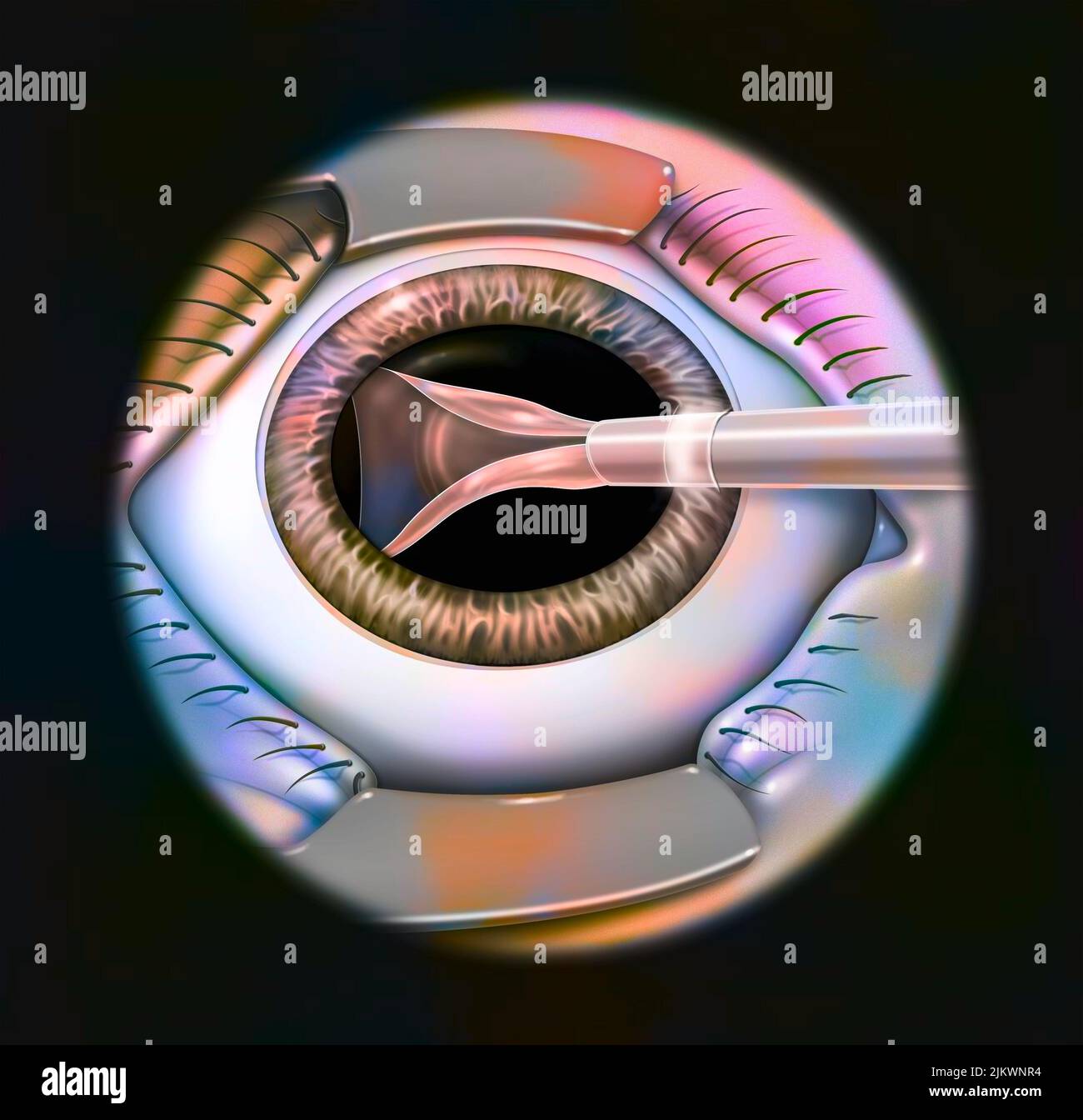 Eye, intraocular implant, step 2: the intraocular implant is folded ...