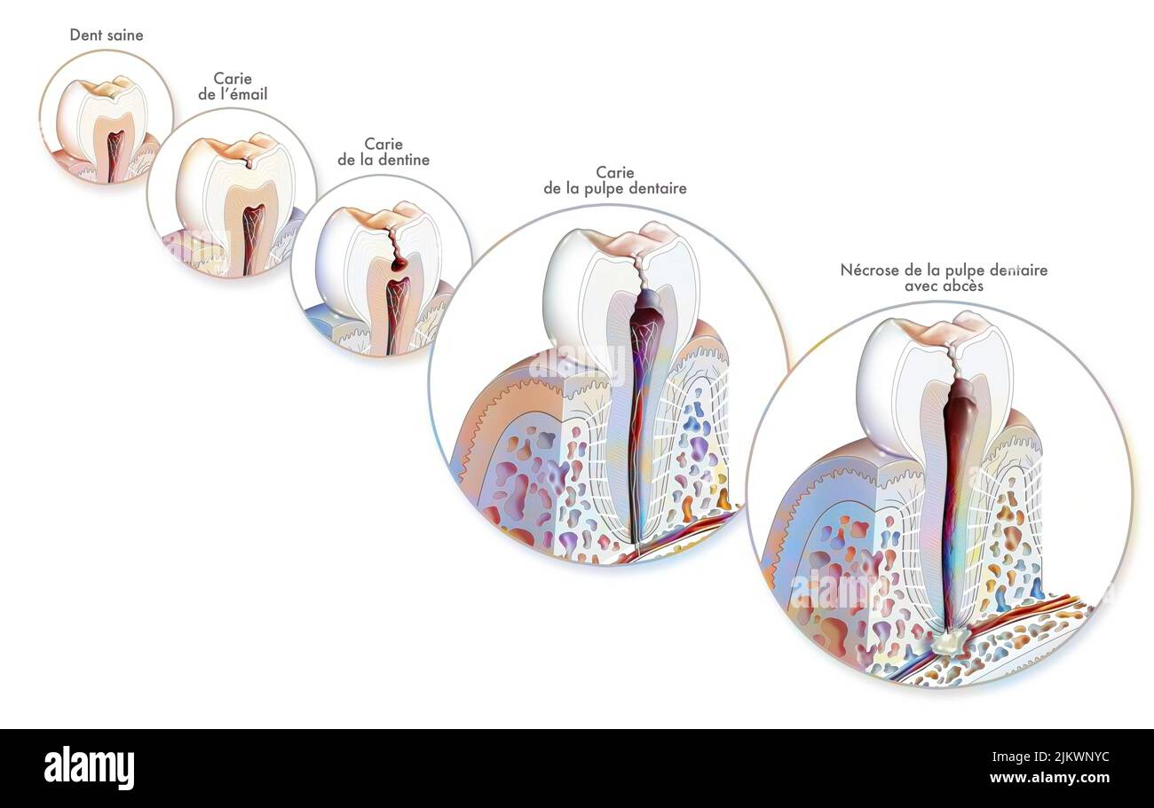 Tooth: formation and development of dental caries Stock Photo - Alamy