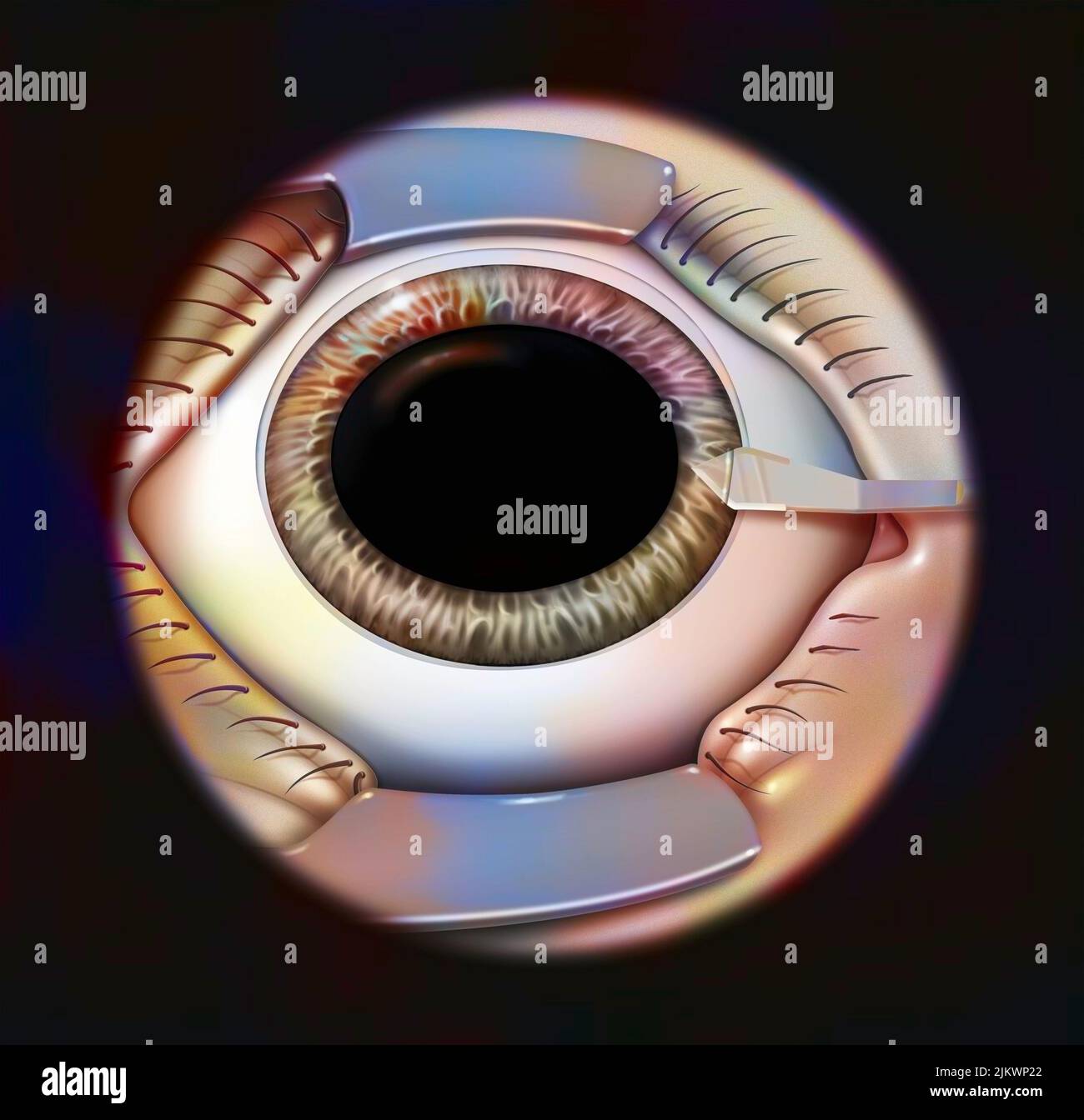 Anterior chamber intraocular lenses hi-res stock photography and images ...