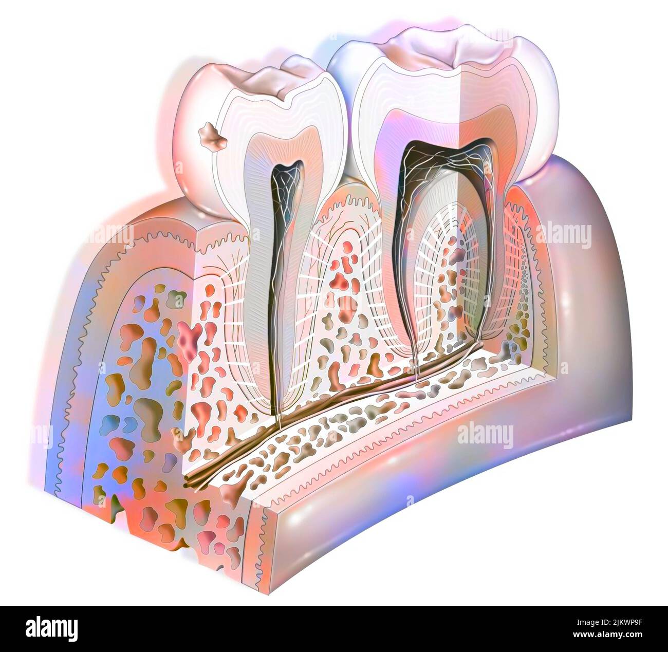 Dental plaque: first stage tooth decay Stock Photo - Alamy