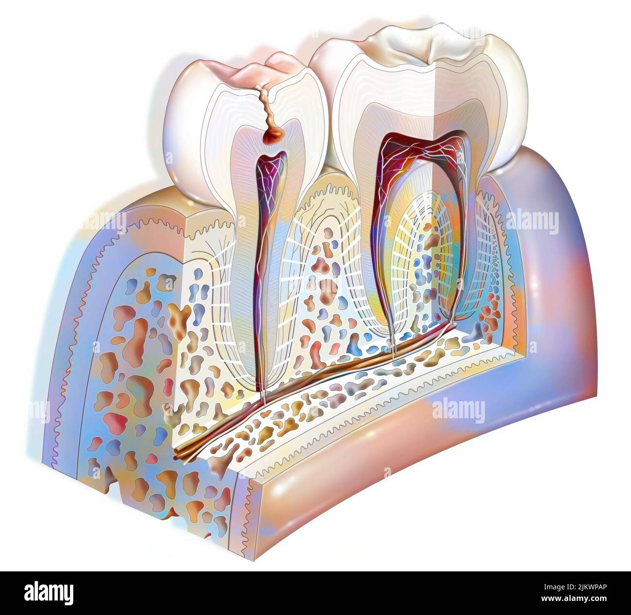 Dental carie, drawing hi-res stock photography and images - Alamy