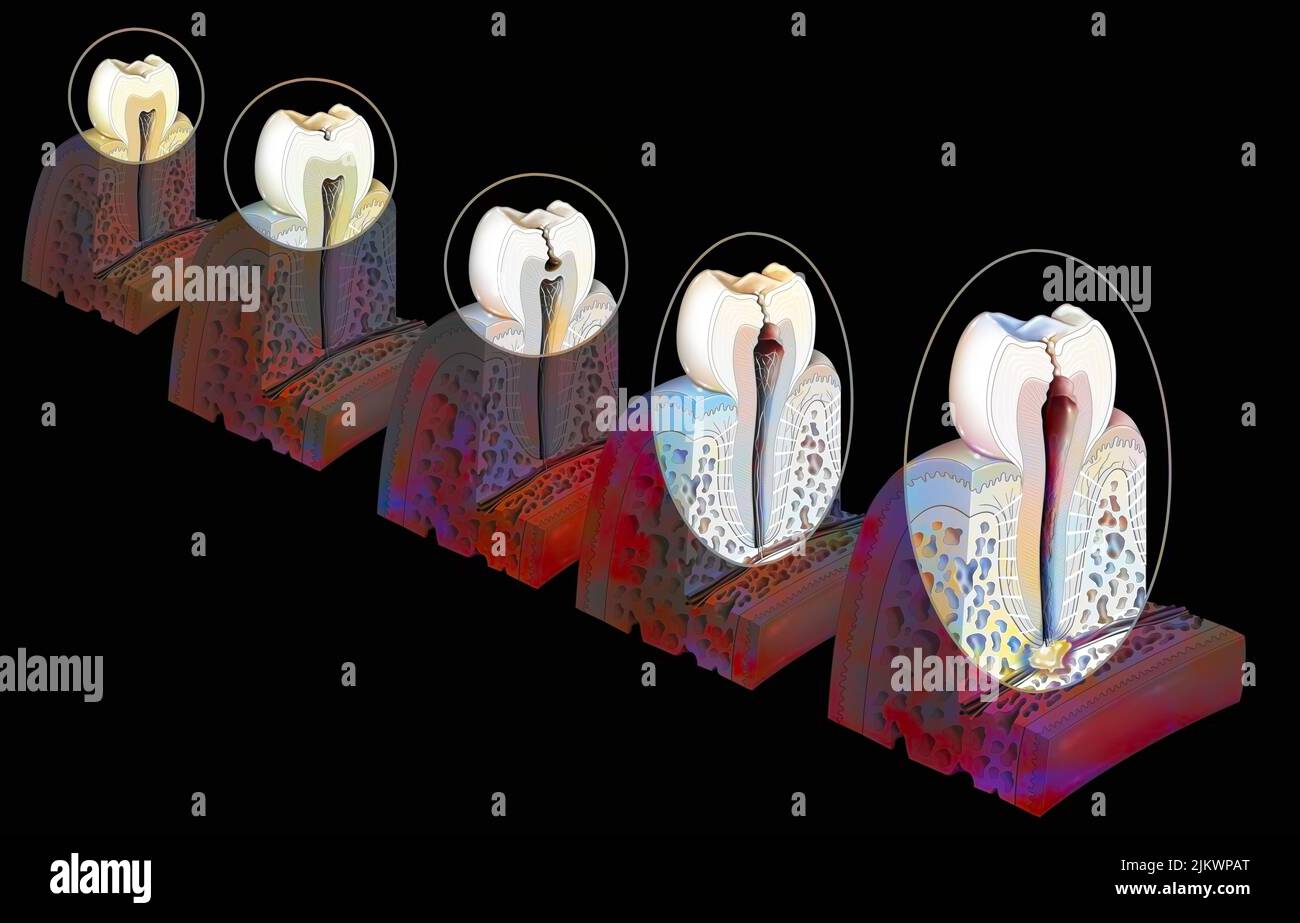 Tooth: formation and development of dental caries Stock Photo - Alamy