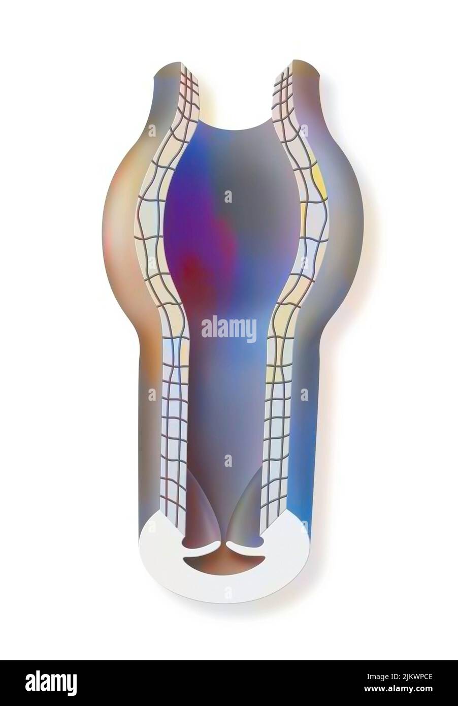 Varicose vein: the internal lumen of the vein is irregular and dilated ...