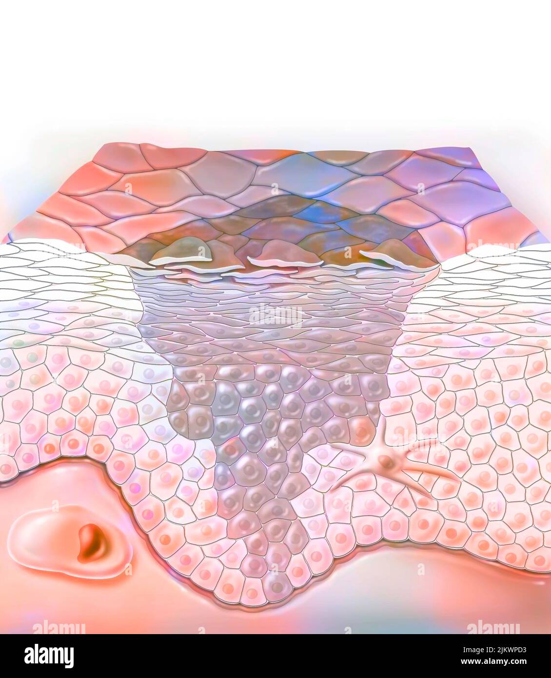 Skin, keratosis: thickening of the horny layer of the epidermis Stock ...