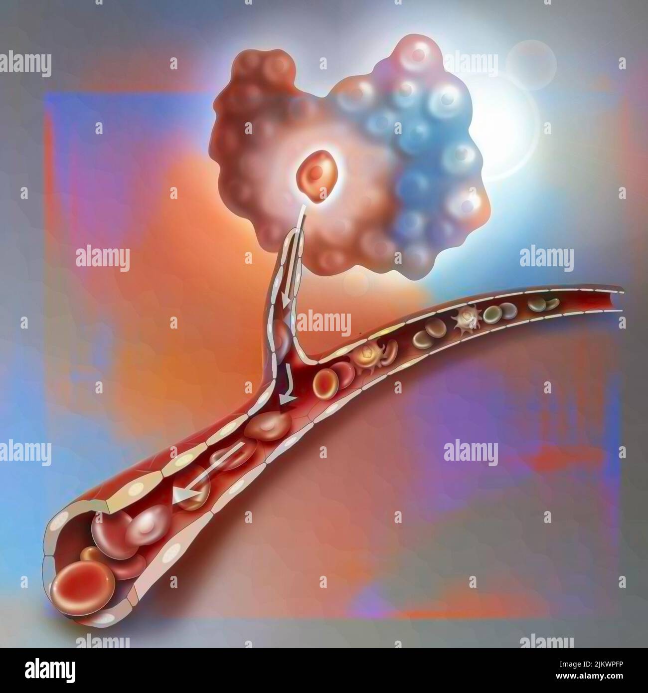 Tumor cells in blood vessel hi-res stock photography and images - Alamy