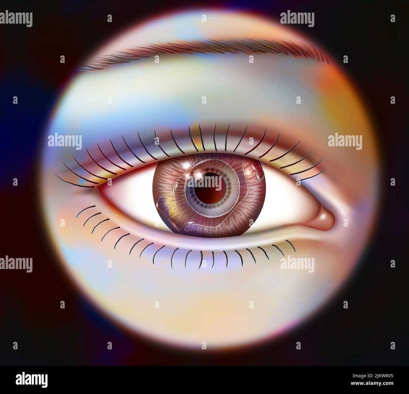 An intraocular implant, clipped to the iris, was placed in the ...