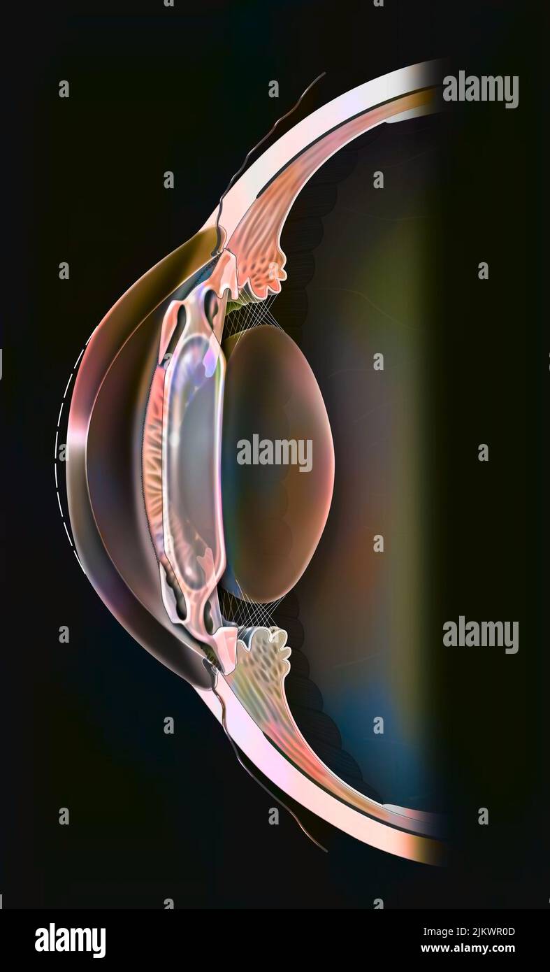 Prosthetic intra ocular lens implants hi-res stock photography and ...