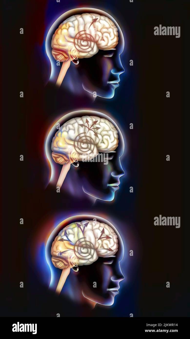 Different stages of epileptic seizure: partial seizure, partial seizure ...