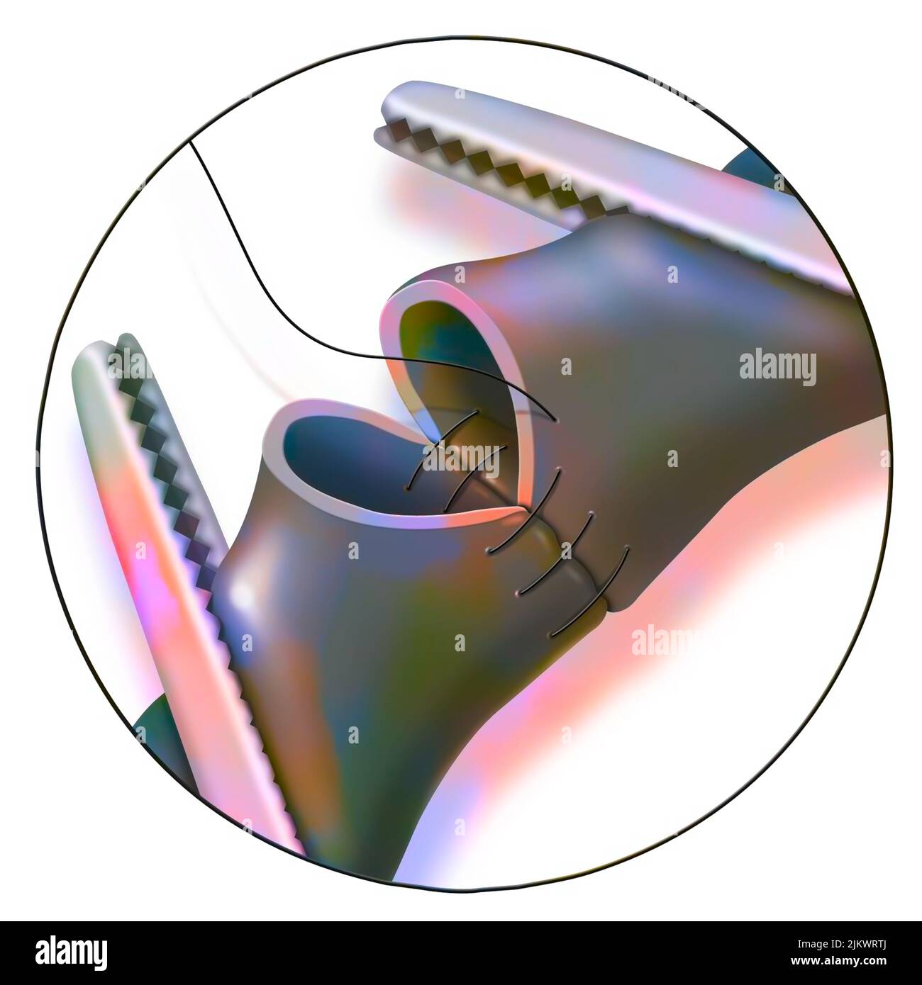 Blood vessels: suture between two arteries during a transplant Stock ...