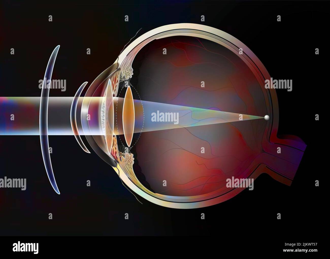 Different possible corrections of a presbyopic eye: spectacle lenses ...