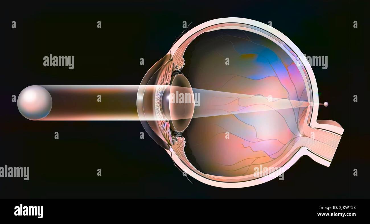 Presbyopic eye with the formation of the image behind the retina Stock ...