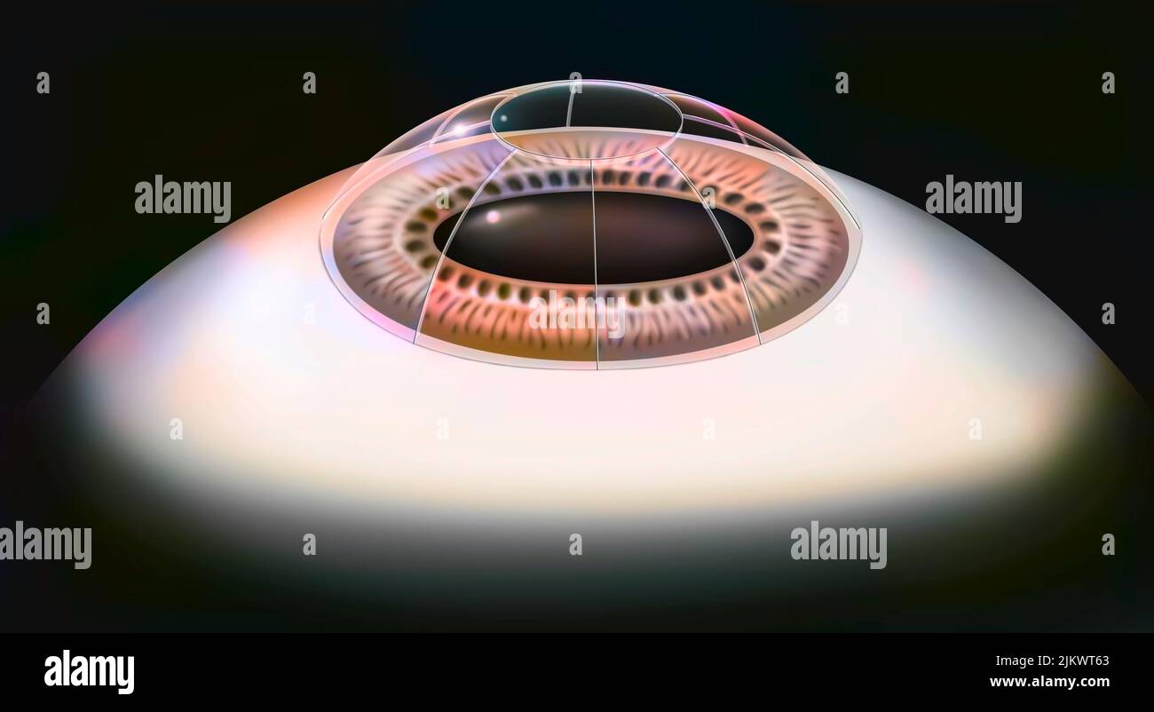 Eye, surgery, radial keratotomy: corneal incisions with a diamond knife ...