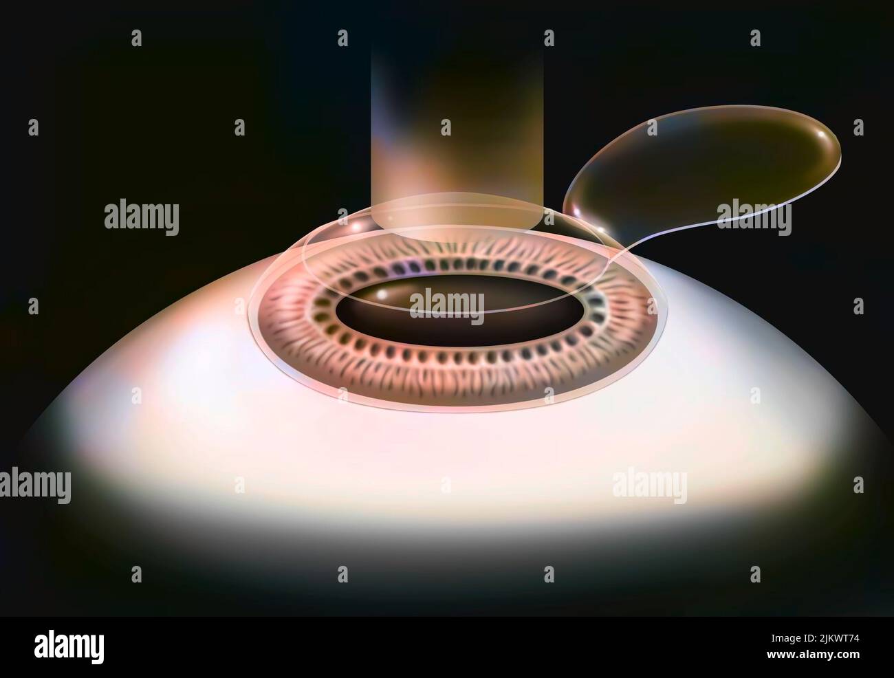 Eye, surgery, Lasik step 3: the cornea is reshaped with the excimer ...