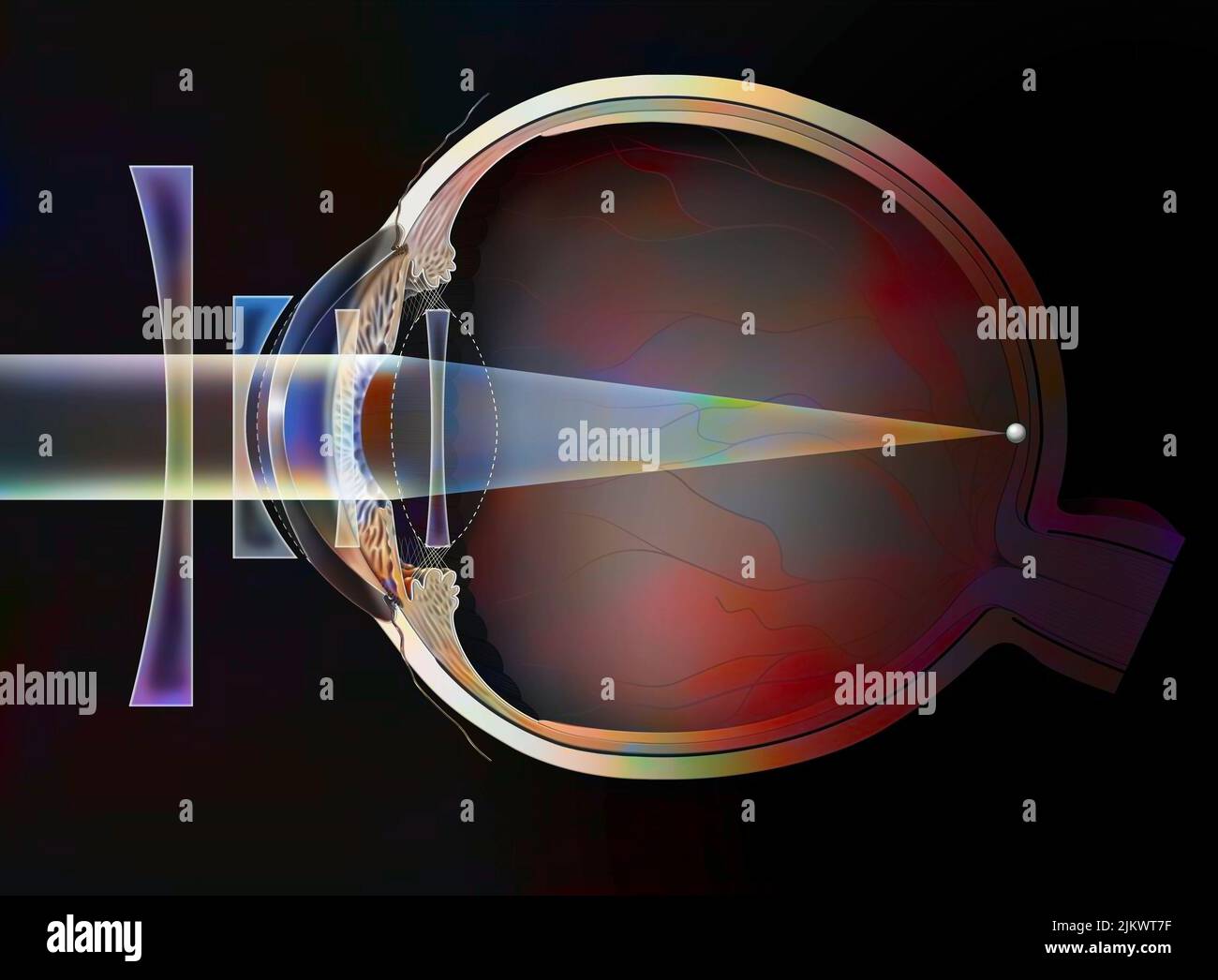 Prosthetic intraocular lenses hi-res stock photography and images - Alamy