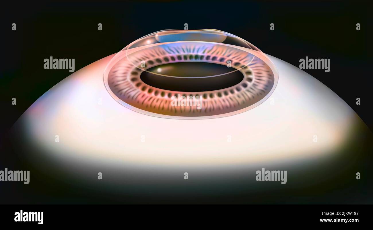 Corneal lens hi-res stock photography and images - Alamy