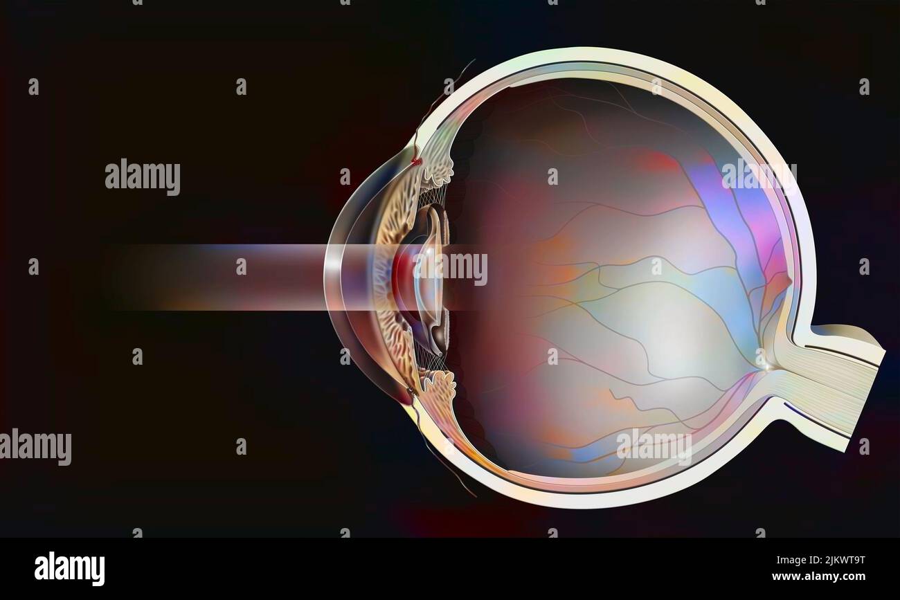 Sectional eye with secondary cataract treated with YAG laser Stock ...