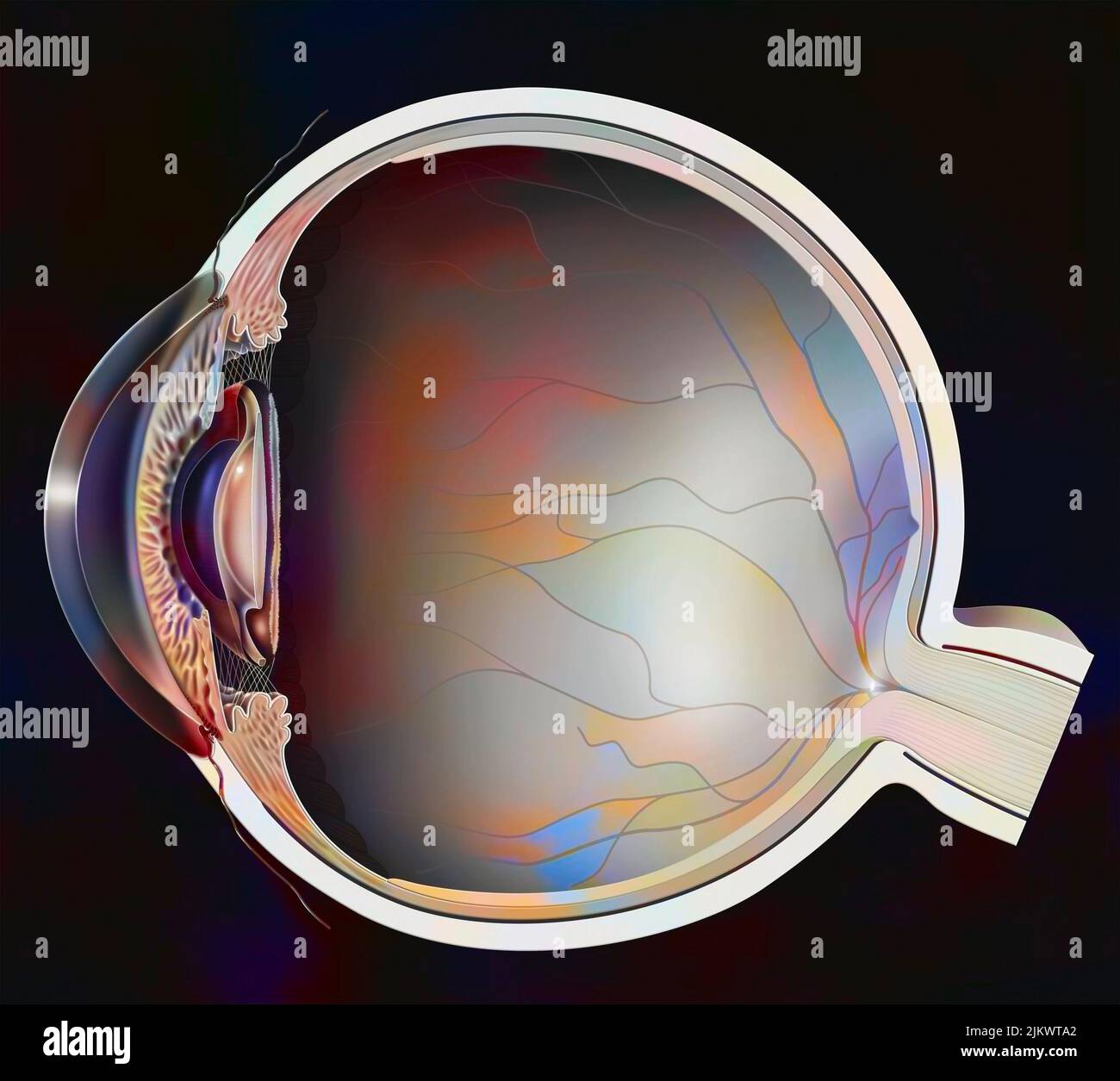 Eye (secondary cataract): clouding of the posterior lens capsule Stock ...