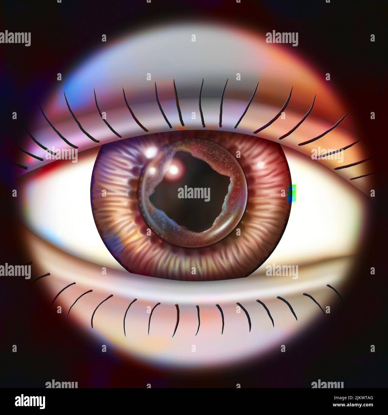 Eye with secondary cataract treated with YAG laser Stock Photo - Alamy