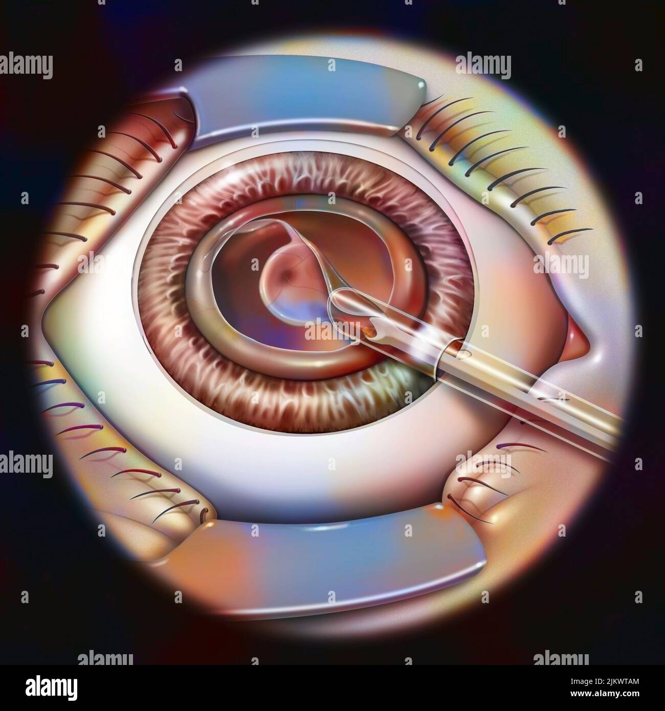 Eye, cataract, phacoemulsification - step 3: placement of the implant ...