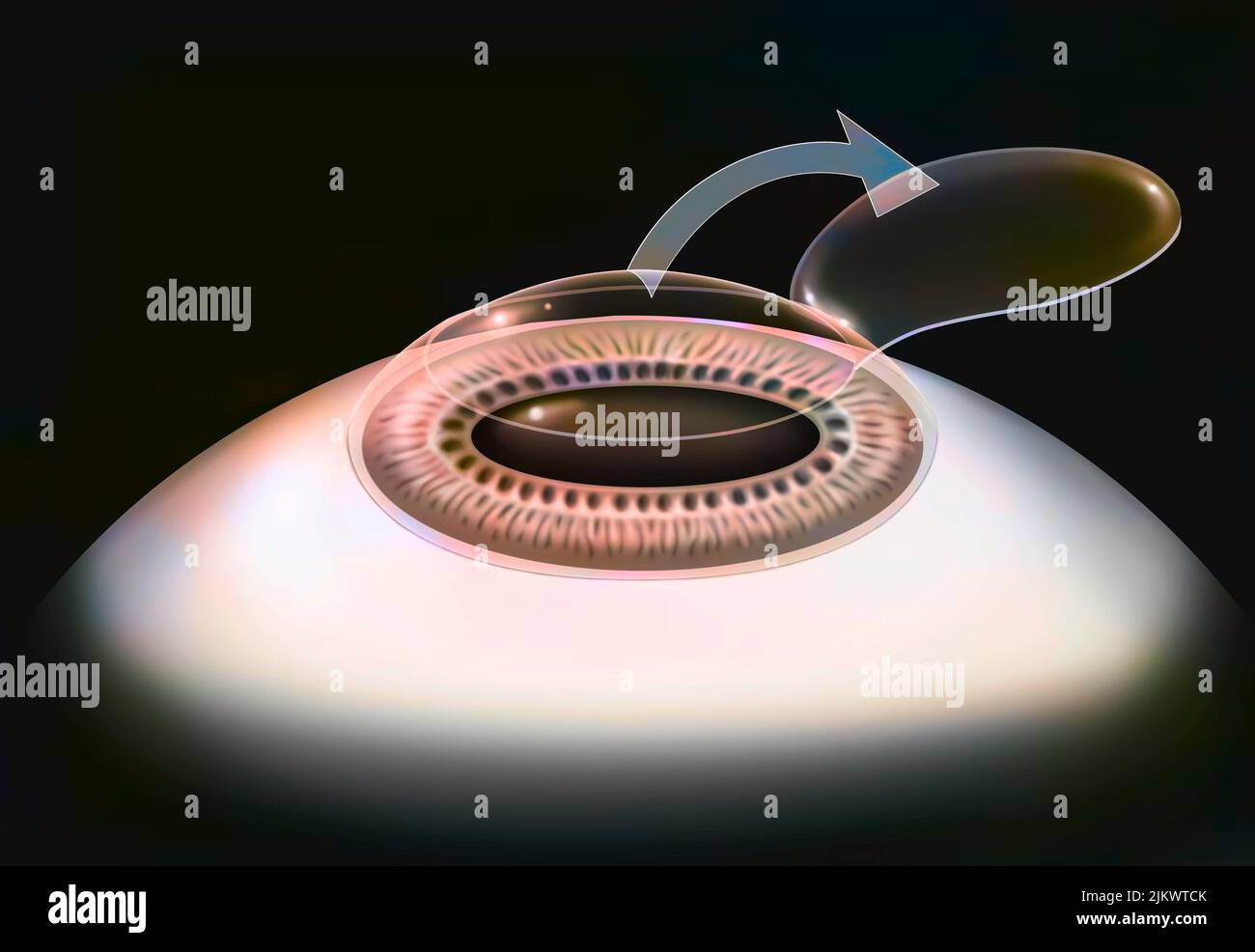 Eye, surgery, Lasik step 2: the corneal flap is raised Stock Photo - Alamy