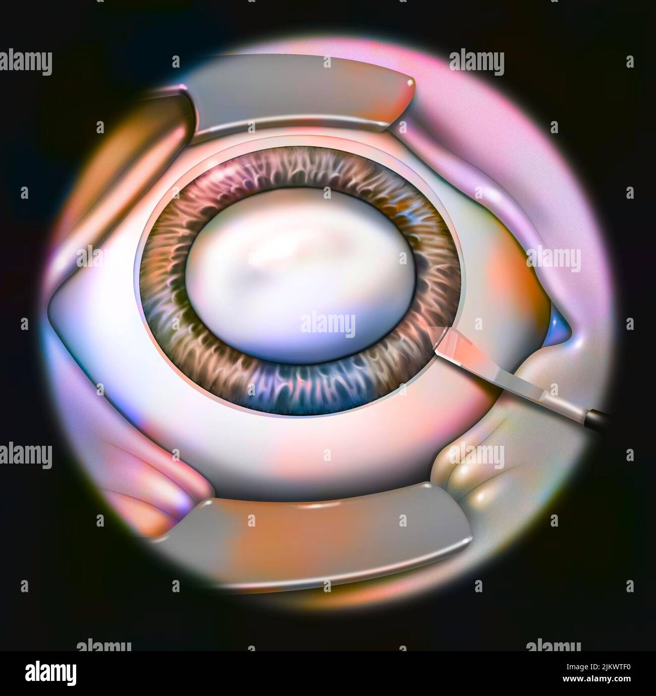 Eye, cataract, phacoemulsification - step 1: making the self-sealing ...