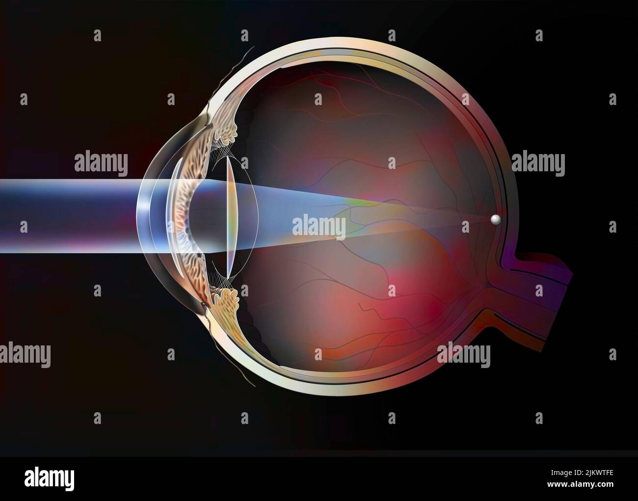 Eye, cataract: intraocular implants in anterior and posterior chamber ...