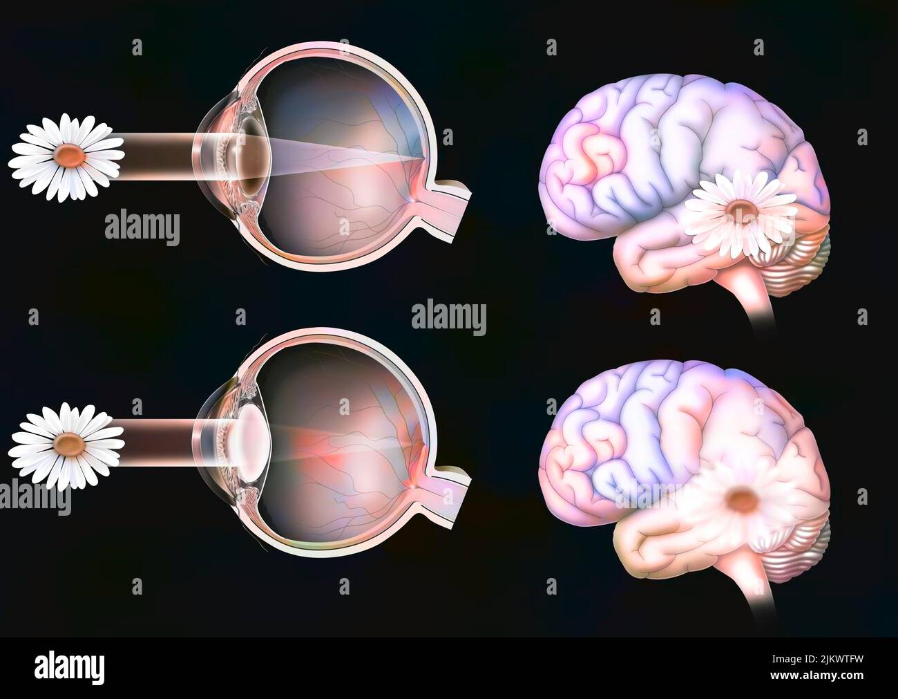 Comparison between normal vision and that of an eye with cataract Stock ...