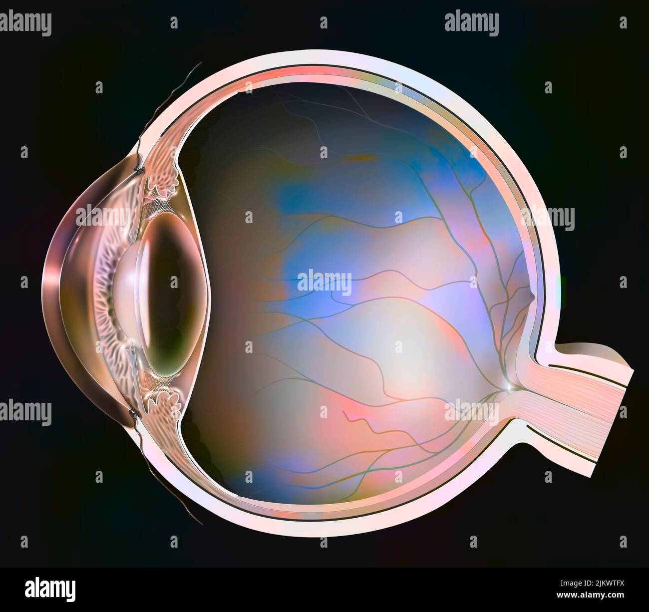 Anterior sub capsular cataract hi-res stock photography and images - Alamy