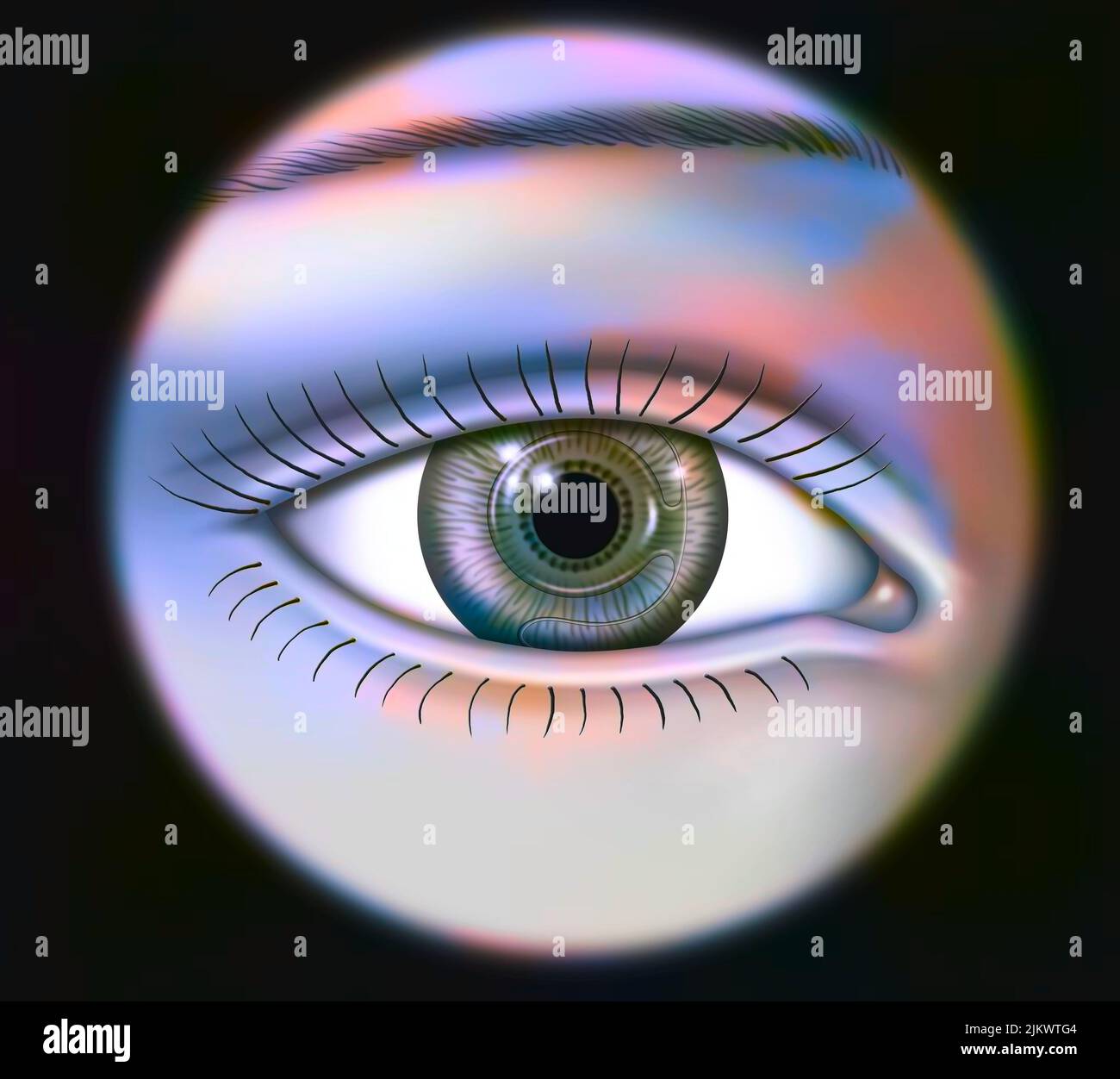 Eye, refractive surgery: placement of an intraocular implant Stock ...