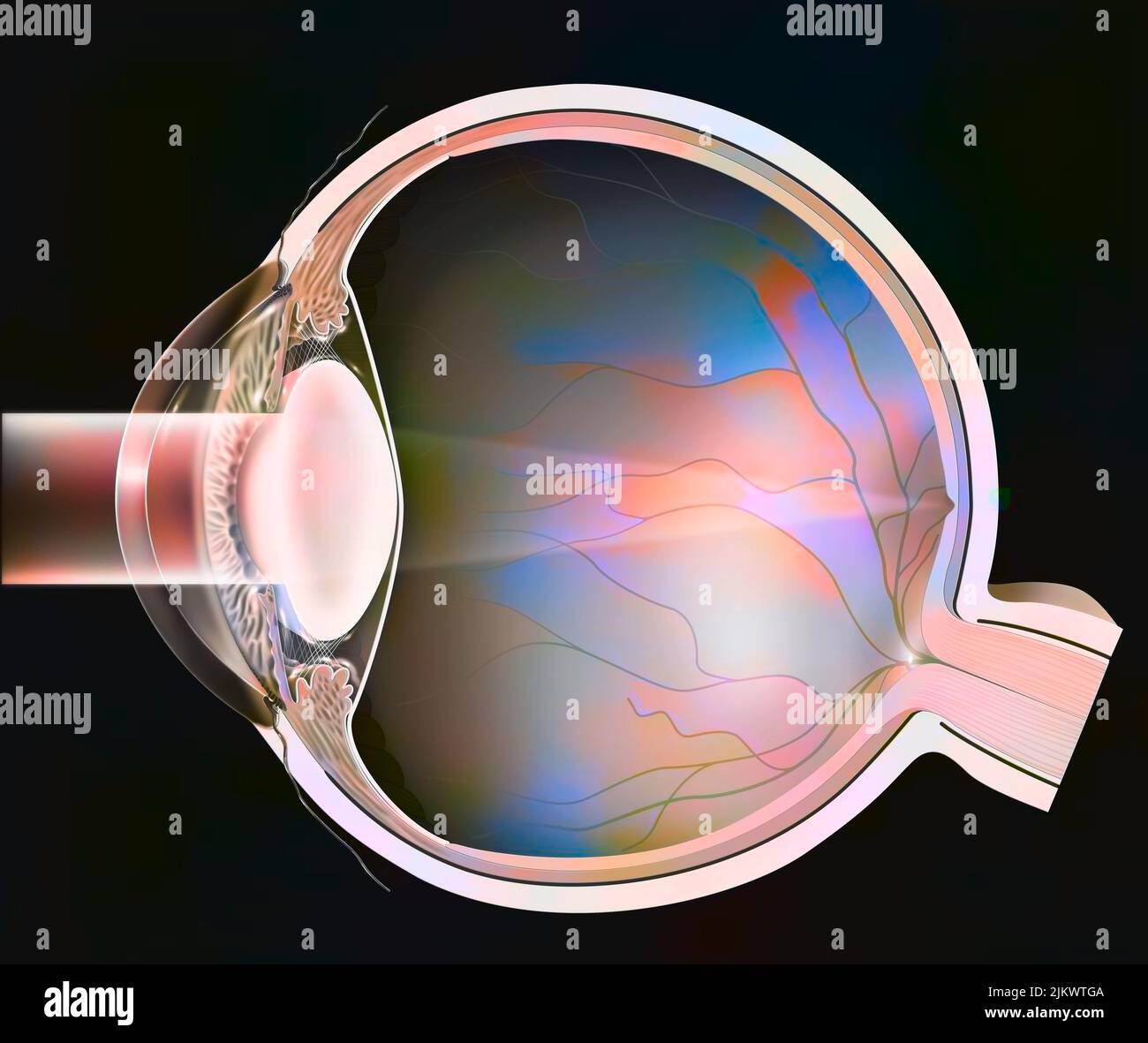 Vision of the eye with a cataract hi-res stock photography and images ...