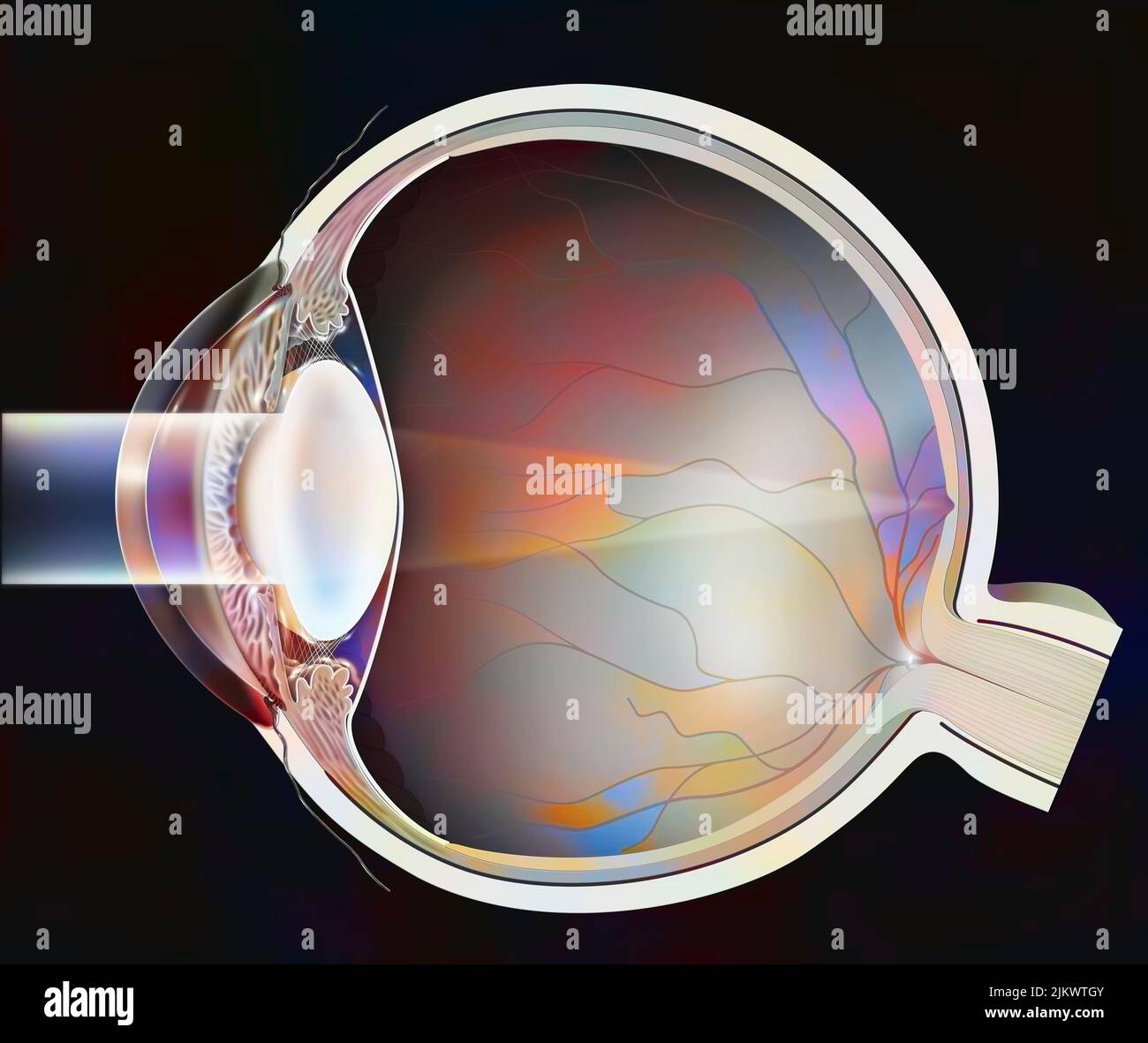 Eye: sagittal section of a lens with severe cataract Stock Photo - Alamy