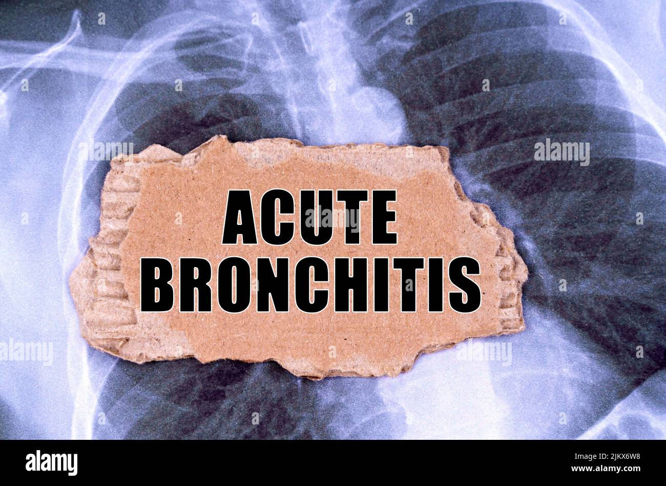 Chest x ray bronchitis hi-res stock photography and images - Alamy