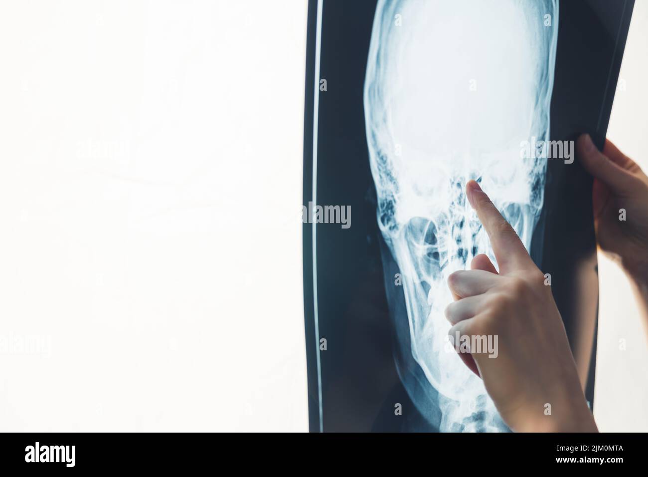 Hand pointing at x-ray photo of human skull close-up studio shot ...