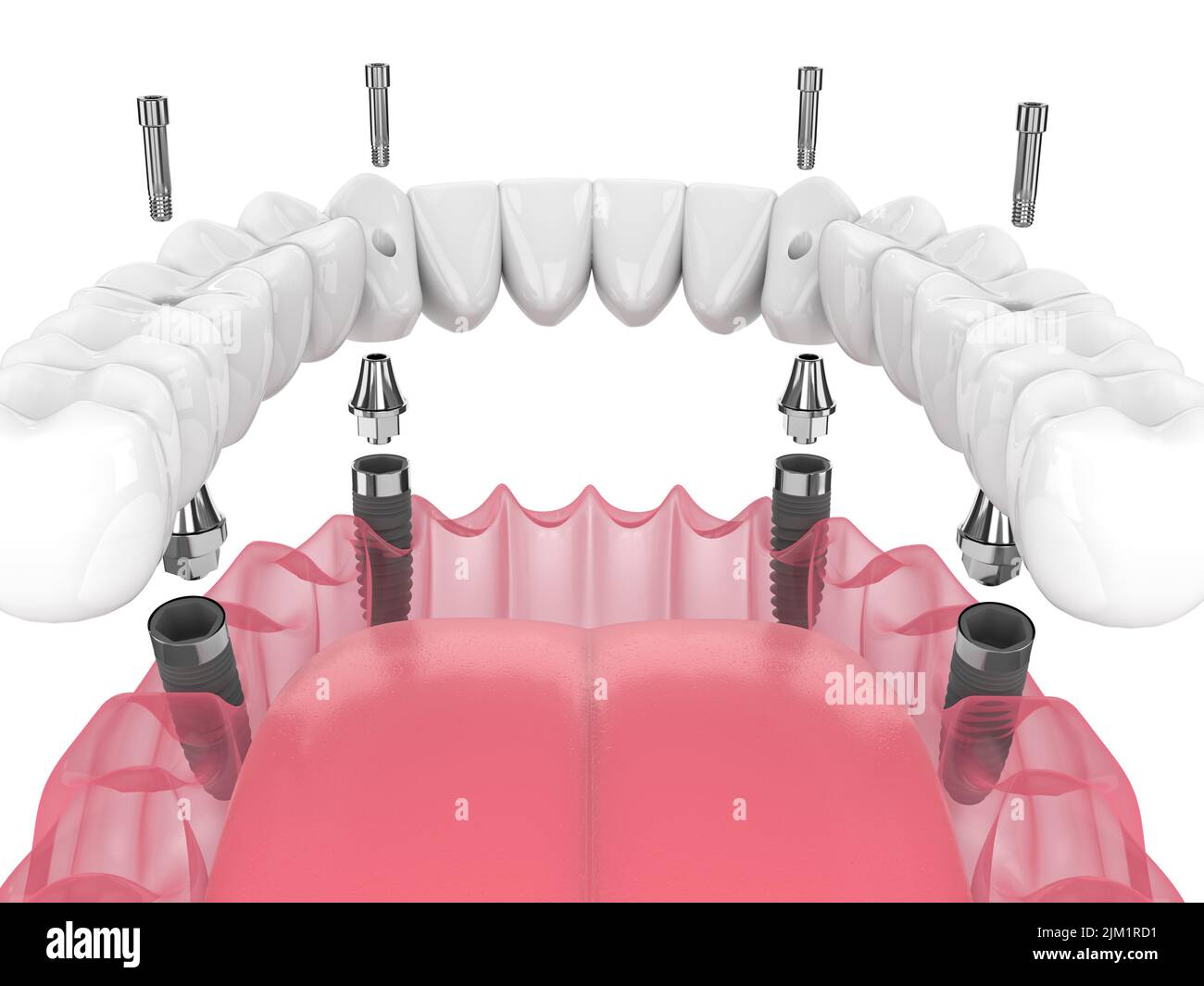 Mandibular prosthesis all on 4 system supported by implants over white ...