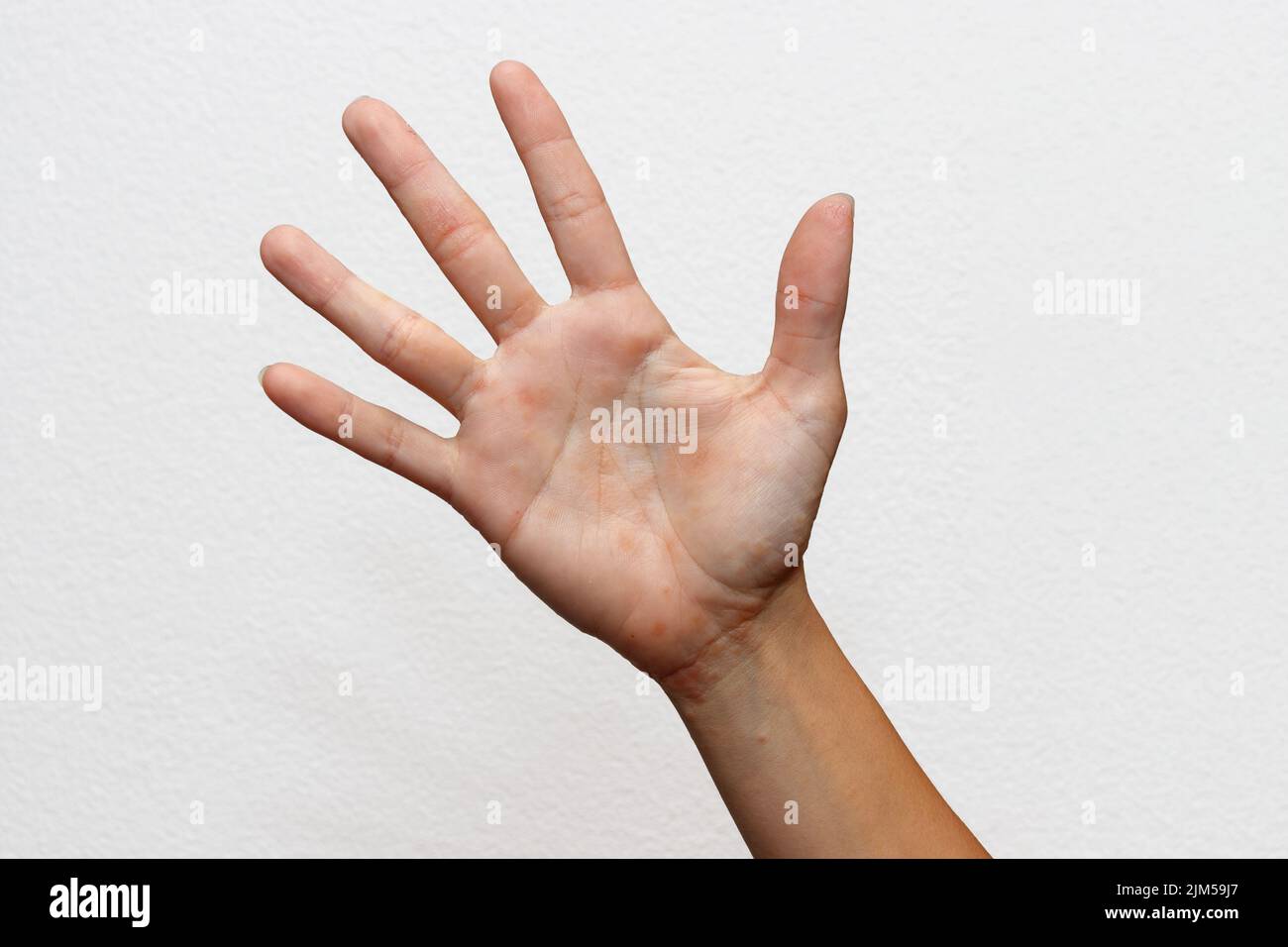 Dyshidrotic eczema skin disease on palms against white background Stock ...